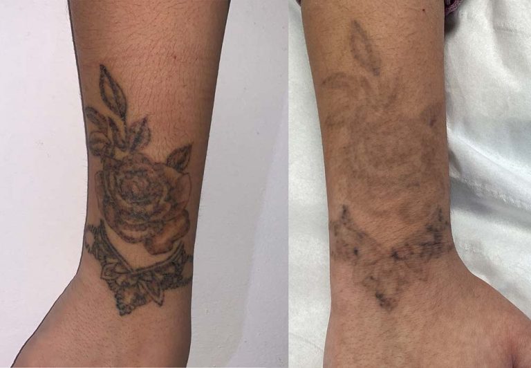 Tattoo Removal - Real Body Clinic